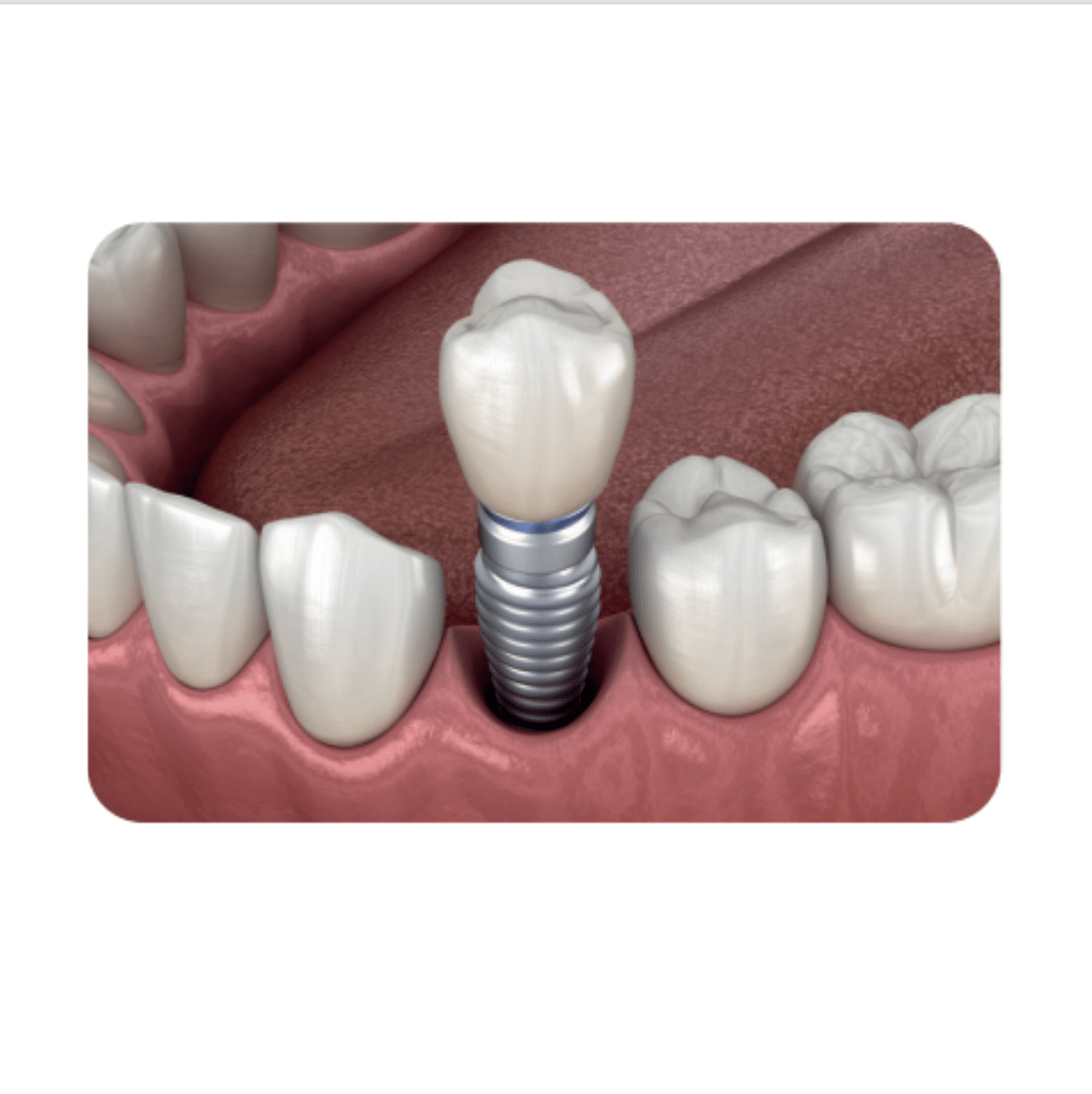 Prothèses scellées sur implant - La Prothèse Française